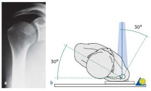 Supraspinatus Outlet View Shoulder X Ray | semashow.com