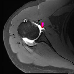 MRI-Labral-tear-shoulder-dislocation-dr-Sujit-Jos - Docjoints | Dr ...