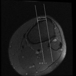 Radiological Measurements in Patellar instability - Docjoints | Dr ...