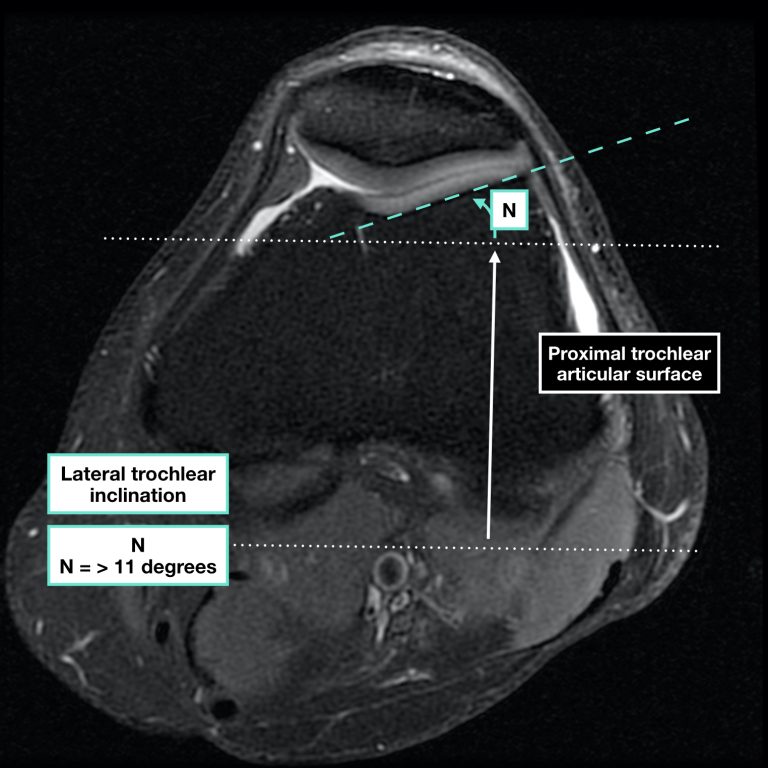 Radiological Measurements in Patellar instability - Docjoints | Dr ...