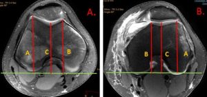 Radiological Measurements in Patellar instability - Docjoints | Dr ...
