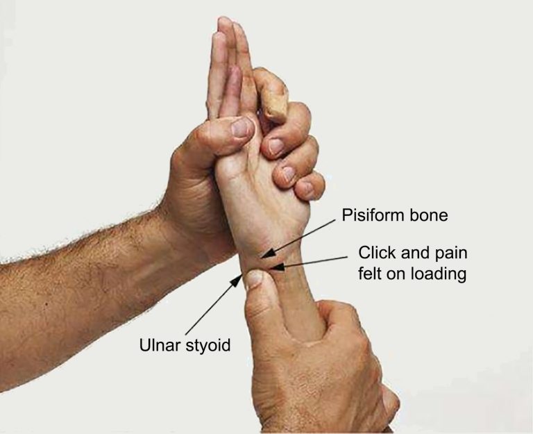 TFCC (Triangular FibroCartilge Complex) Injuries of the wrist joint ...
