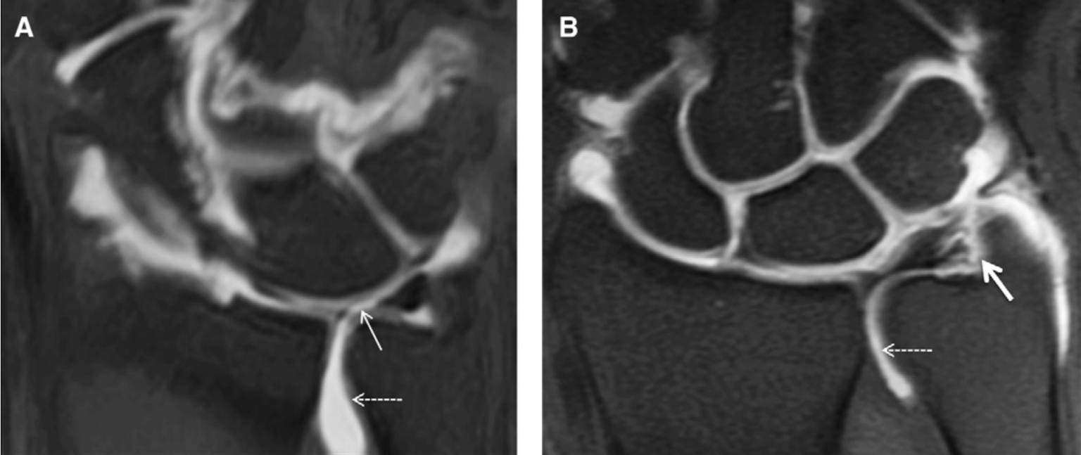 TFCC (Triangular FibroCartilge Complex) Injuries of the wrist joint ...